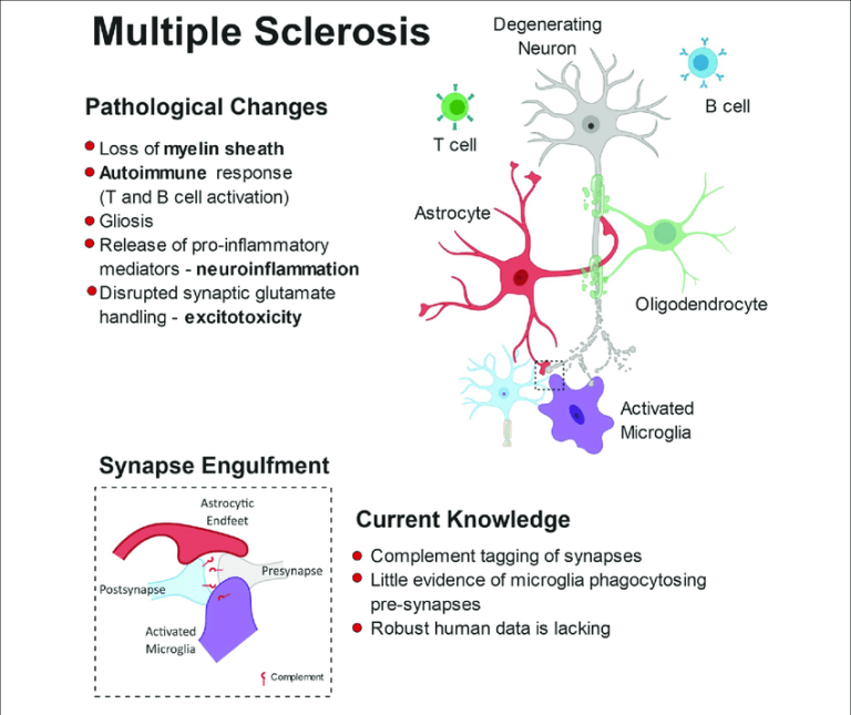 Multiple Sclerosis (MS), Causes, Signs, Symptoms and Treatment – Ensocure